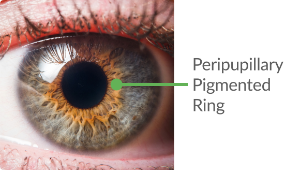 Pigmented ring in iris - English | SneakPeek®️